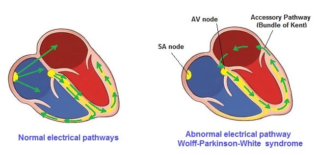 WPW kent 03 | Acil Çalışanları