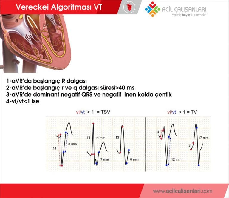 Ventriküler Taşikardi (VT) - Acil Çalışanları