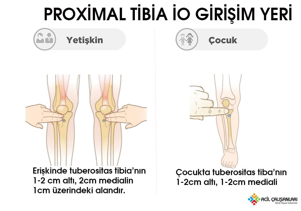 Proksimal Tibia İntraosseöz Girişim Uygulama | Acil Çalışanları