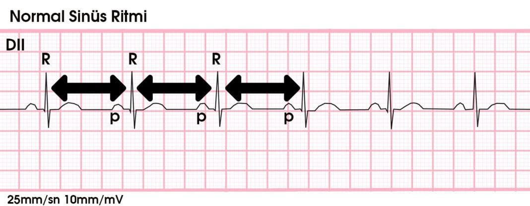 EKG Yorumlama - Acil Çalışanları
