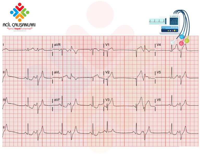 Anterior Miyokard İnfarktüsü | Acil Çalışanları