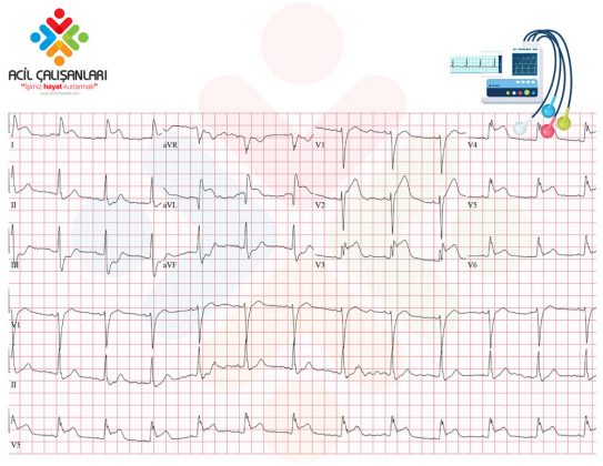 Anterior Miyokard İnfarktüsü | Acil Çalışanları