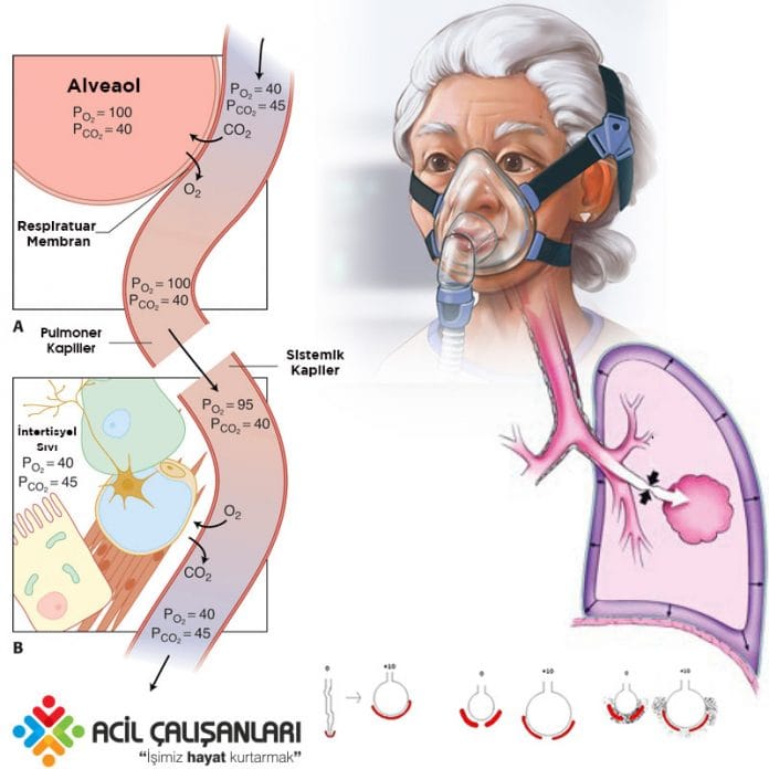 Non İnvazif Mekanik Ventilasyon Uygulaması (NIMV) | Acil Çalışanları