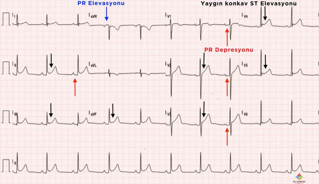 Perikardit Acil Yaklaşım - Acil Çalışanları