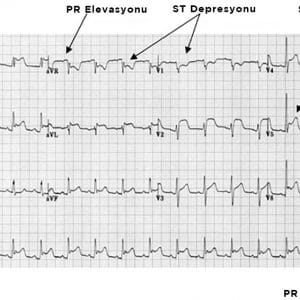 Perikardit-EKG-03 | Acil Çalışanları
