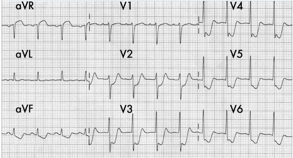 Sol Ana Koroner Arter (LMCA) Tıkanıklığı | Acil Çalışanları
