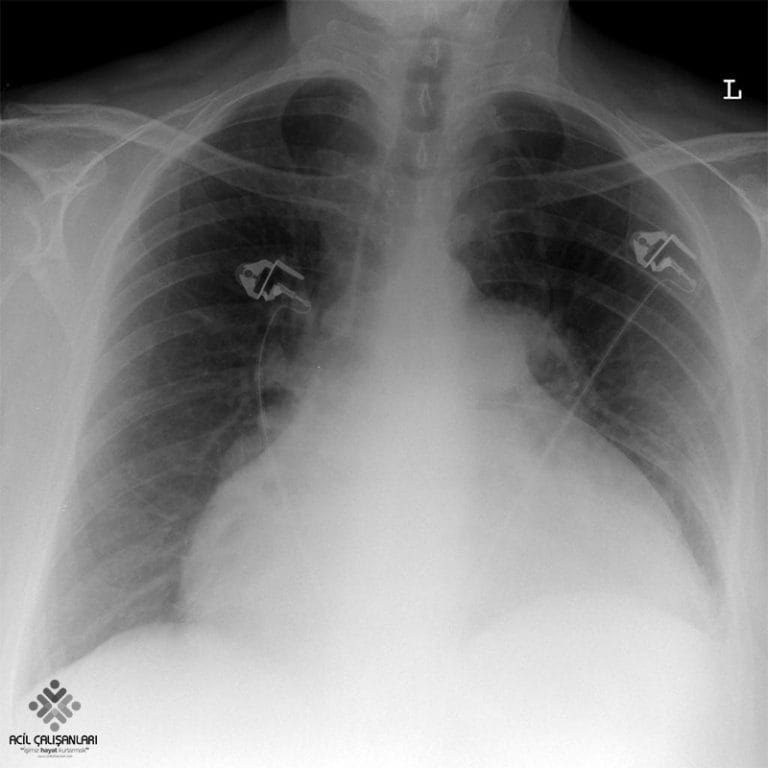 Kardiyak Tamponad | Acil Çalışanları