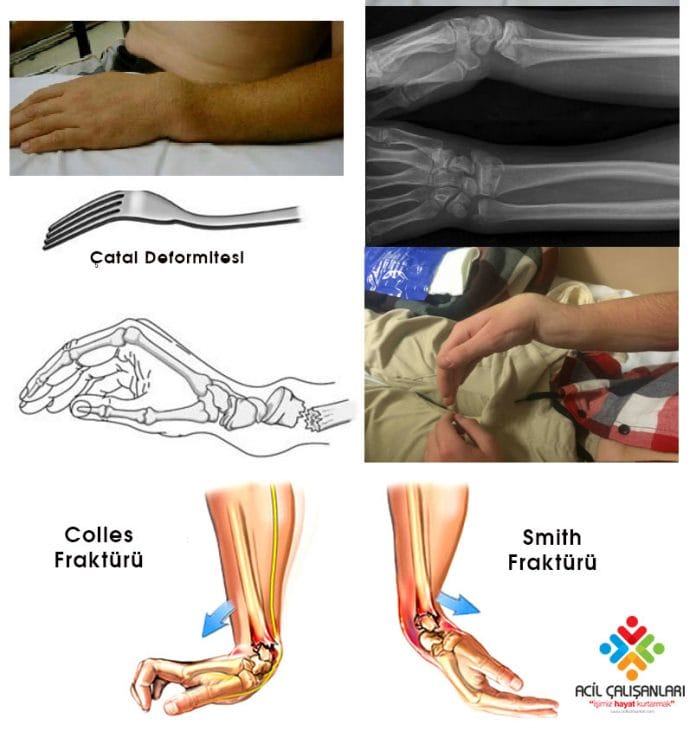 Colles Kırığı | Acil Çalışanları