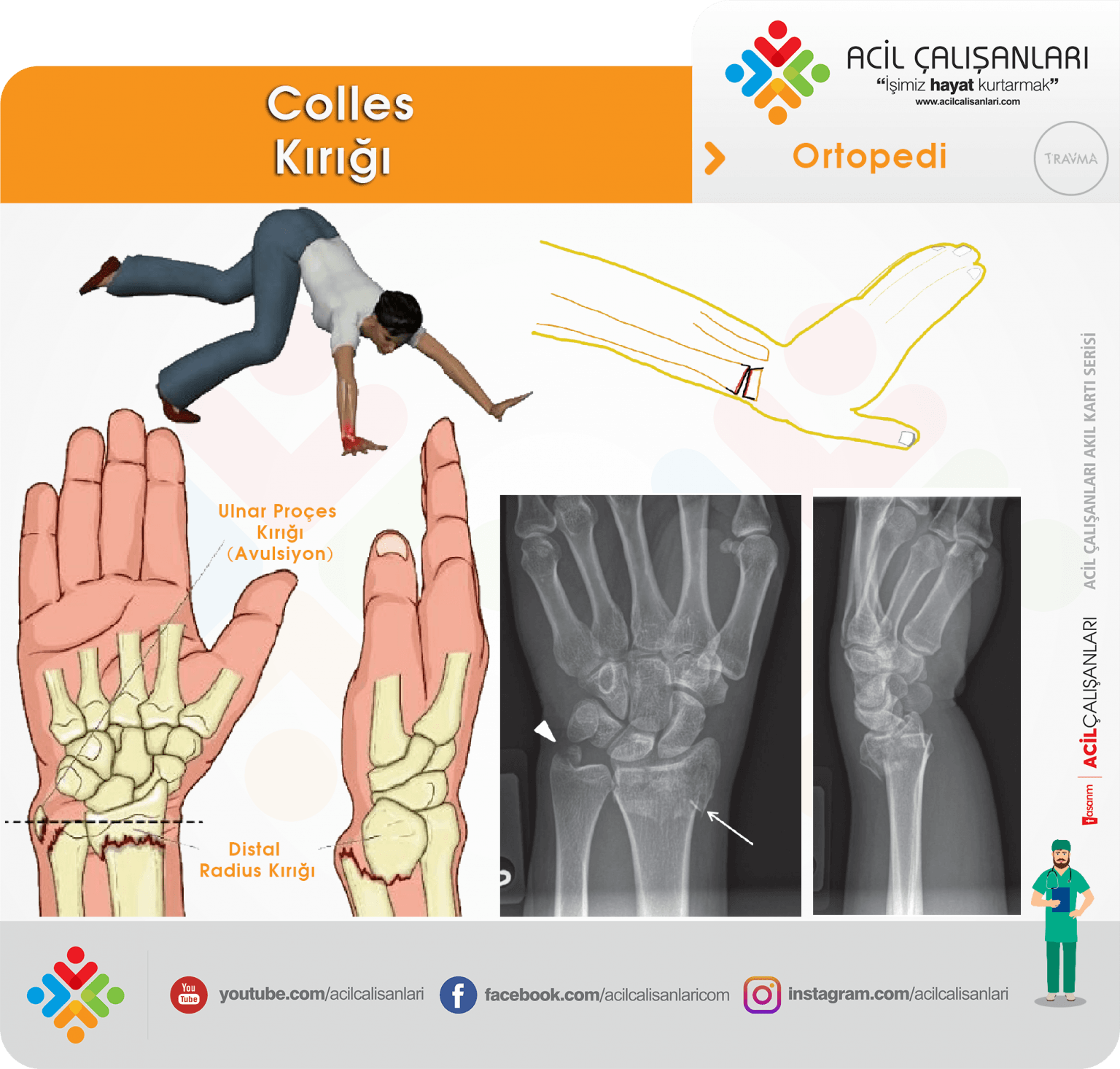 Colles Kırığı | Acil Çalışanları