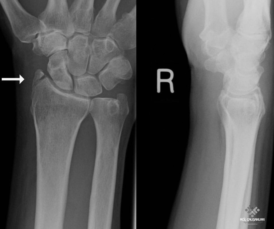 Radial Styloid Kırığı Akıl Kartı | Acil Çalışanları