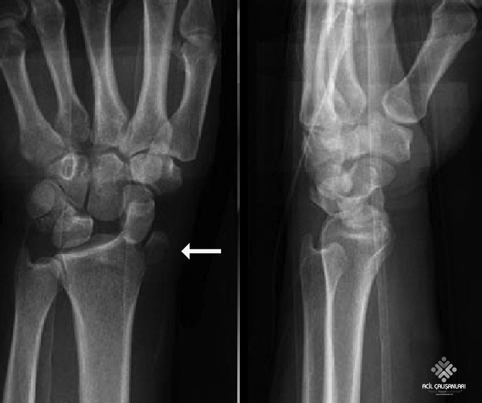 Radial Styloid Kırığı Akıl Kartı | Acil Çalışanları