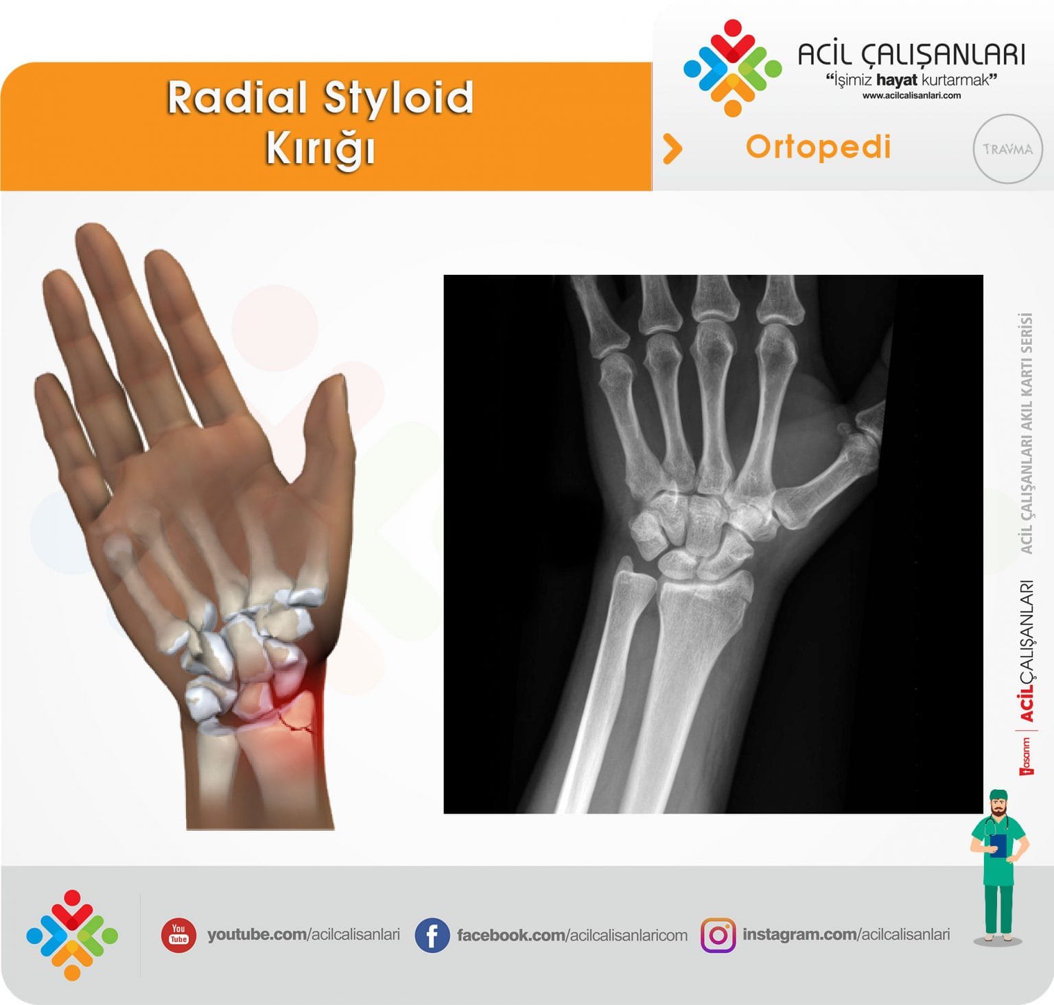 Radial Styloid Kırığı Akıl Kartı | Acil Çalışanları