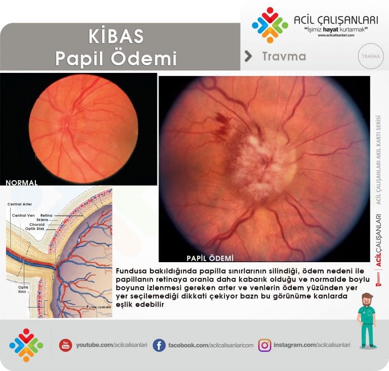 Kafa İçi Basınç Sendromu (KİBAS) - Acil Çalışanları