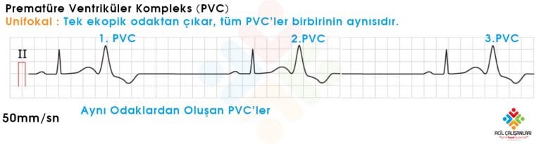 Prematür Ventriküler Kompleks (PVC) | Acil Çalışanları