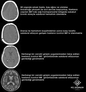 Subdural Kanama Akıl Kartı | Acil Çalışanları