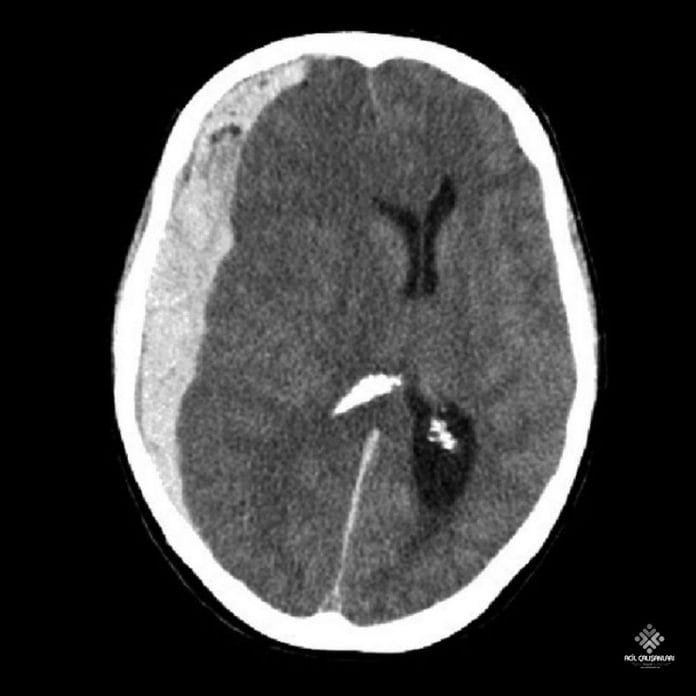 Subdural Kanama Akıl Kartı - Acil Çalışanları