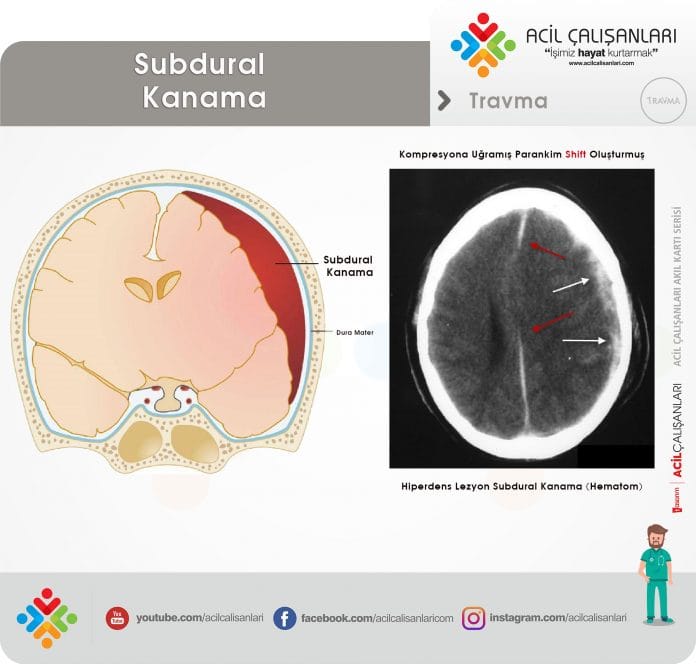 Subdural Kanama Akıl Kartı - Acil Çalışanları