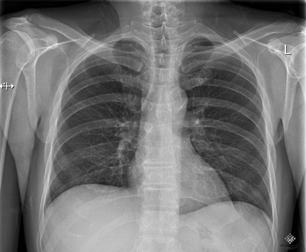 Aslanger EKG Paterni Olgu Sunumu | Acil Çalışanları