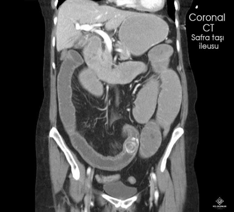 İleus Genel Yaklaşım | Acil Çalışanları