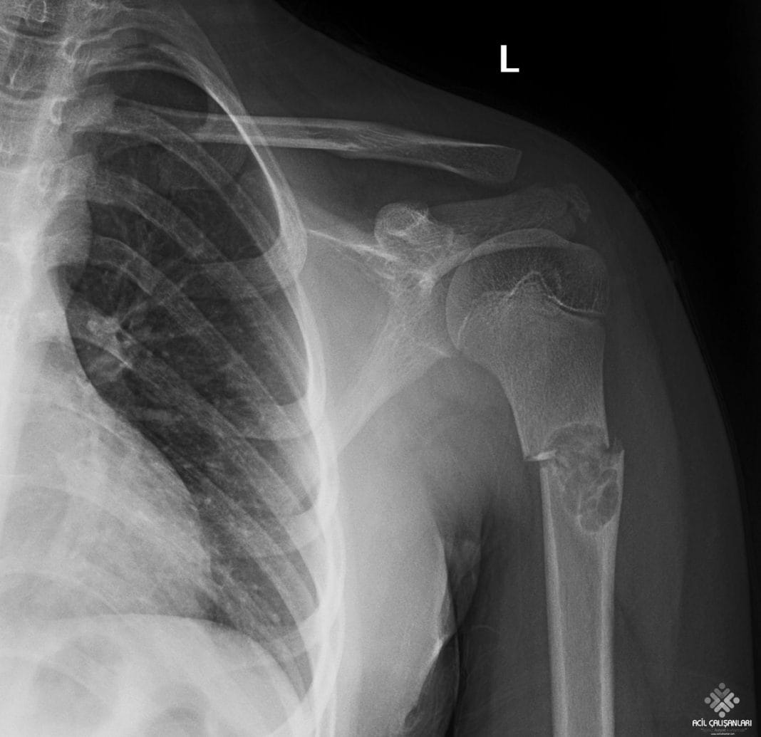 Proksimal Humerus Kırıkları | Acil Çalışanları