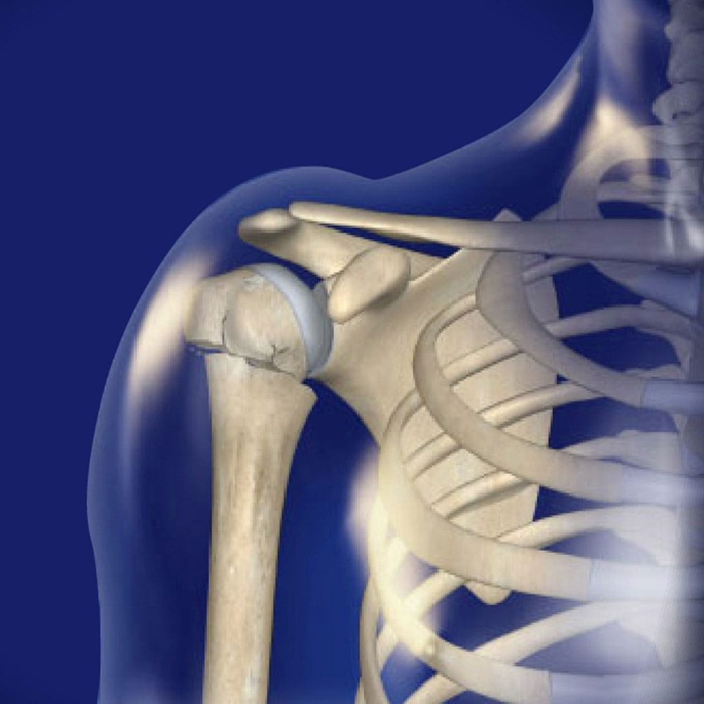 Proksimal Humerus Kırıkları | Acil Çalışanları