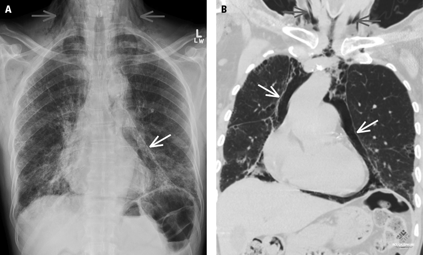 Acilde Toraks BT Değerlendirilmesi | Acil Çalışanları