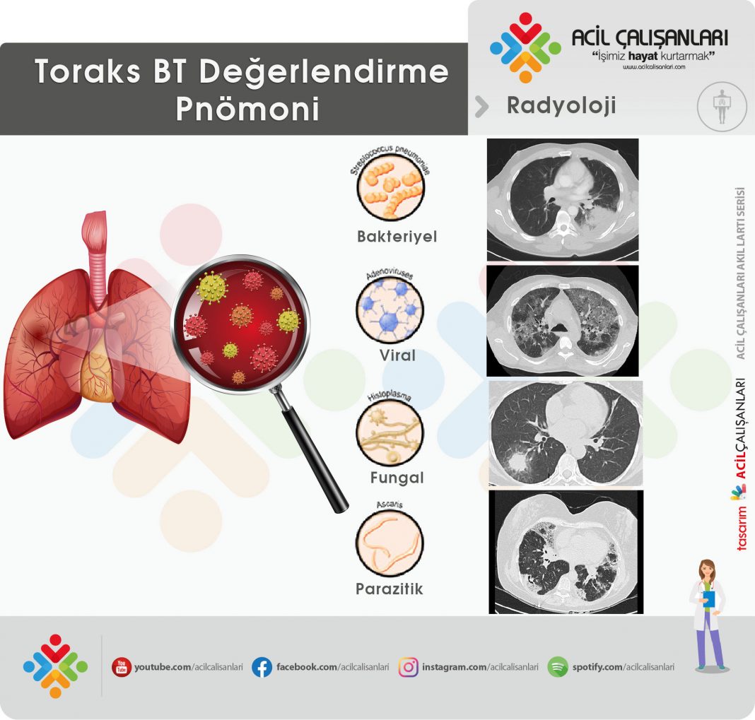 Acilde Toraks BT Değerlendirilmesi | Acil Çalışanları