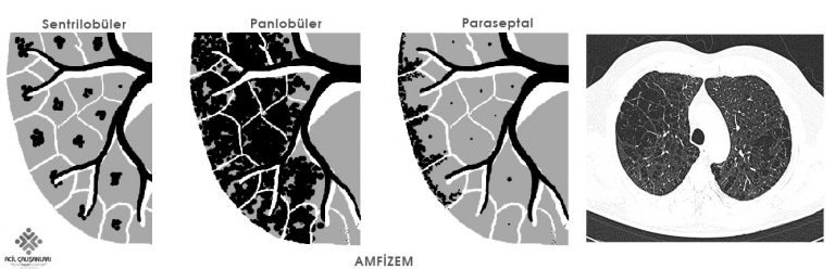 Acilde Toraks BT Değerlendirilmesi | Acil Çalışanları