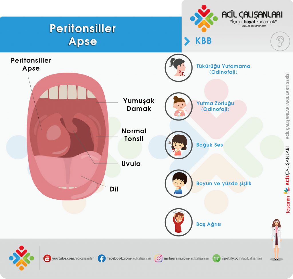 Peritonsiller Apse | Acil Çalışanları