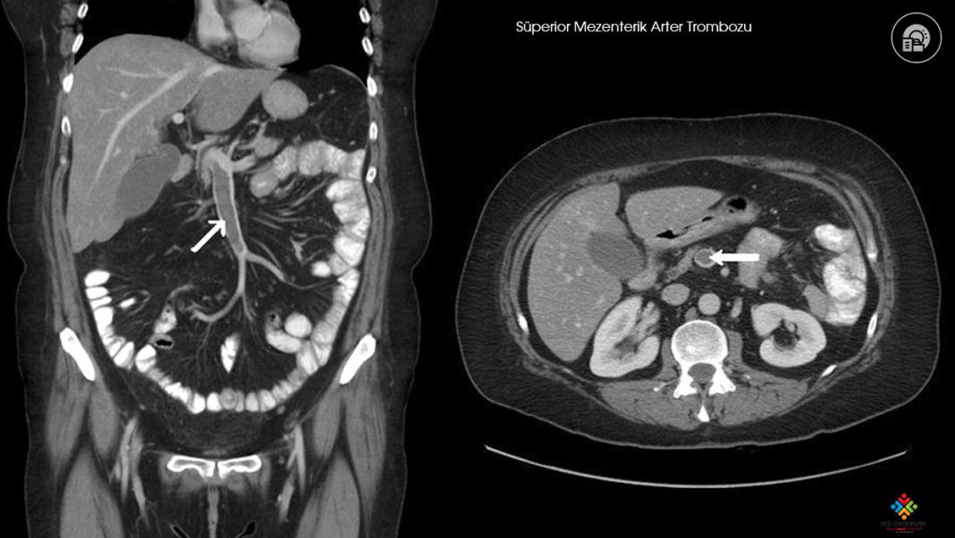 Acilde Abdomen BT Değerlendirilmesi | Acil Çalışanları