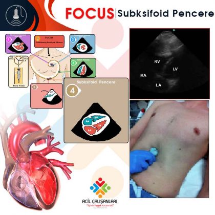 Odaklanmış Kardiyak USG (FOCUS) | Acil Çalışanları