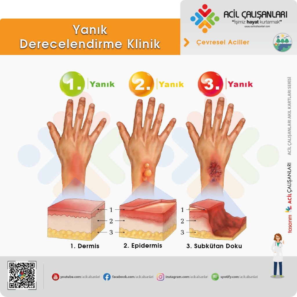 Yanık Reçetesi | Acil Çalışanları