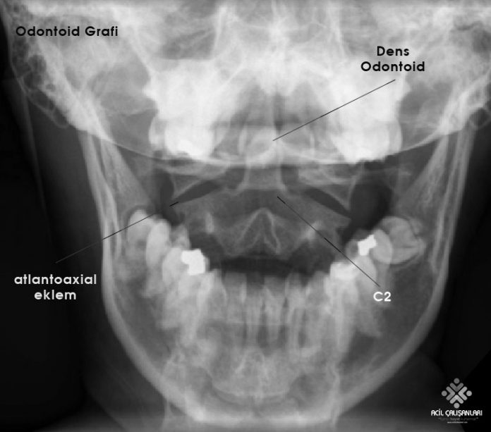 Odontoid (C2 Dens) Fraktürü | Acil Çalışanları