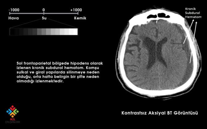 Acil Serviste Nöroradyolojik Görüntüleme | Acil Çalışanları