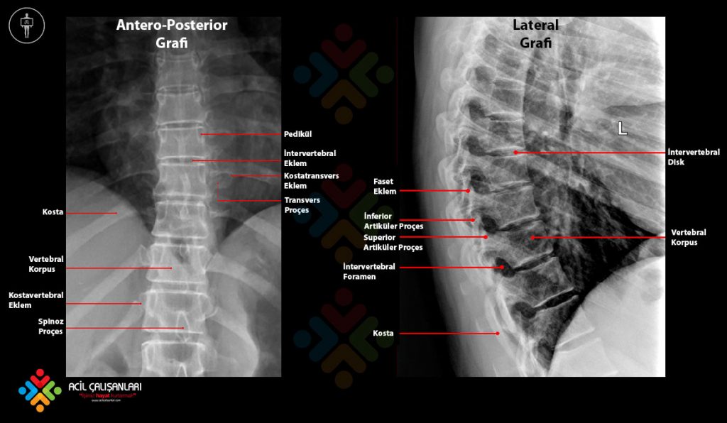 Torakal Vertebra Grafisi Değerlendirilmesi - Acil Çalışanları