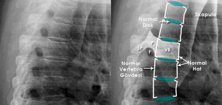 Torakal Vertebra Grafisi Değerlendirilmesi - Acil Çalışanları