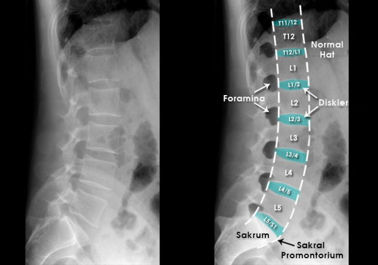 Torakal Vertebra Grafisi Değerlendirilmesi - Acil Çalışanları