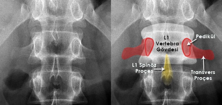 Torakal Vertebra Grafisi Değerlendirilmesi - Acil Çalışanları