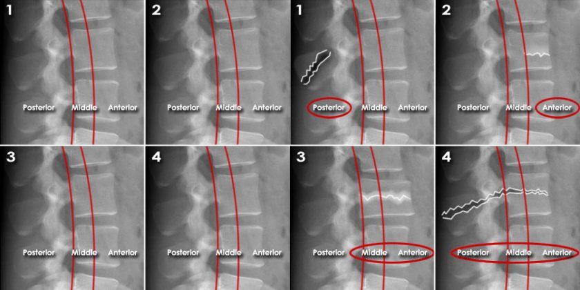 Torakal Vertebra Grafisi Değerlendirilmesi - Acil Çalışanları