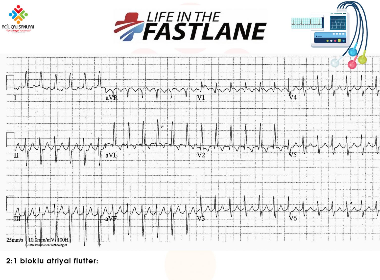 Atrial Flutter - Acil Çalışanları