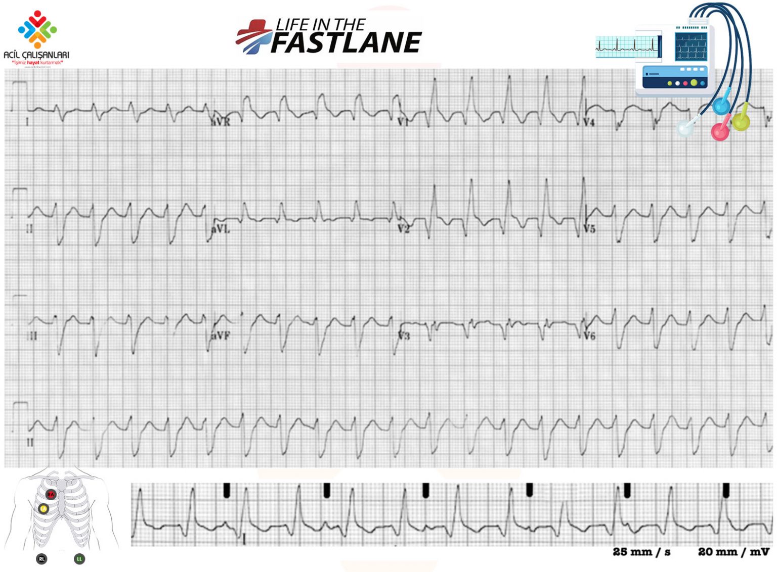 Lewis Derivasyonu (S5 Derivasyonu) | Acil Çalışanları