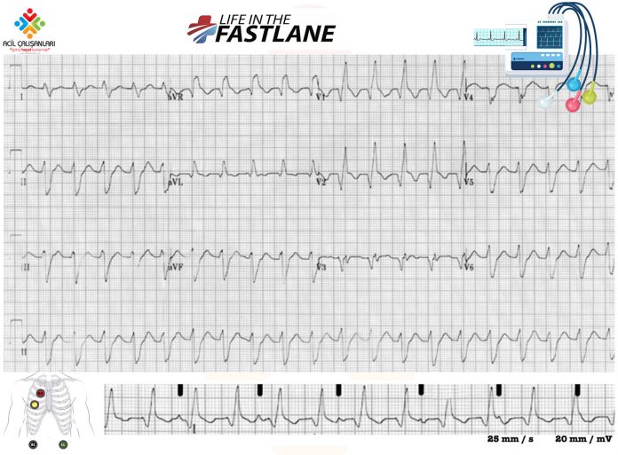 Lewis Derivasyonu (S5 Derivasyonu) | Acil Çalışanları