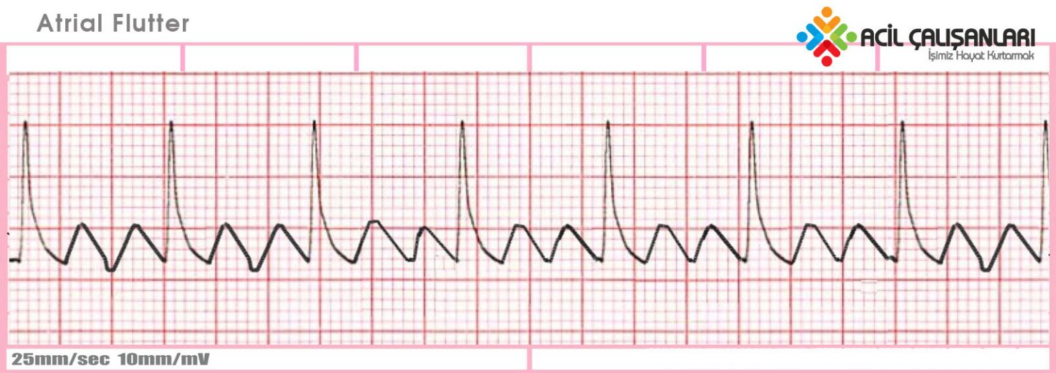 Atrial Flutter - Acil Çalışanları