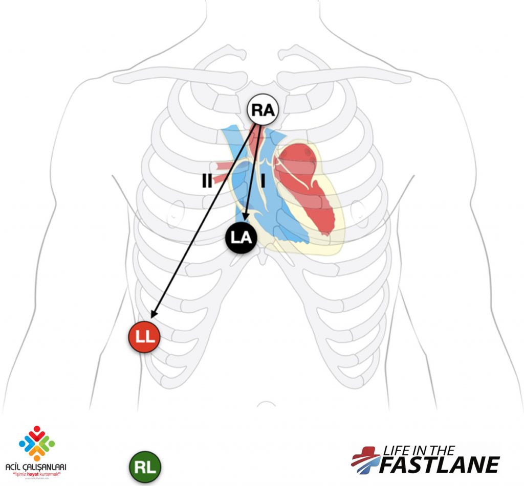Lewis Derivasyonu (S5 Derivasyonu) | Acil Çalışanları