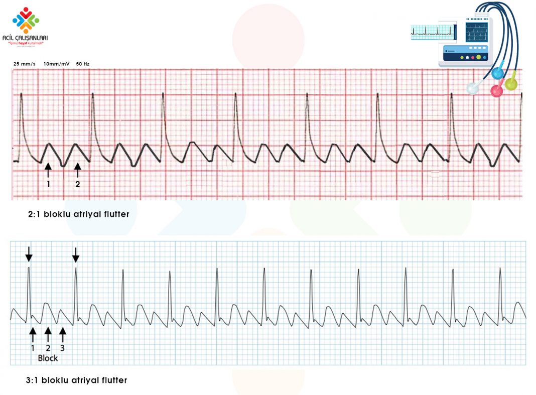 Atrial Flutter - Acil Çalışanları