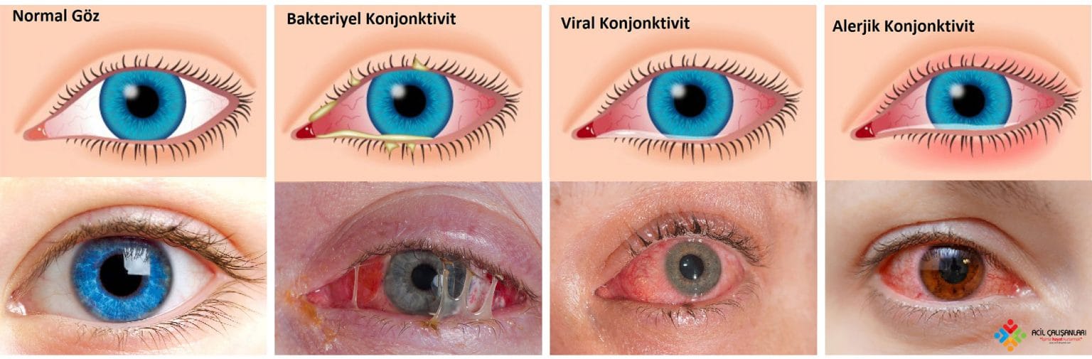 Konjonktivit Acil Yaklaşım - Acil Çalışanları