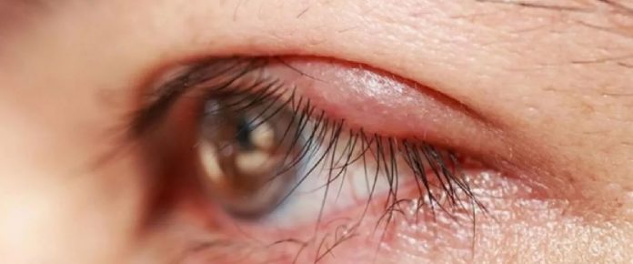 Blefarit Acil Yaklaşım | Acil Çalışanları