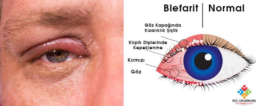 Blefarit Acil Yaklaşım | Acil Çalışanları