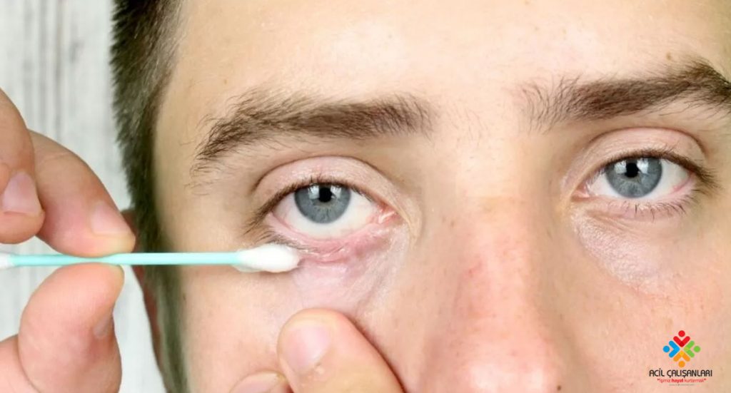 Blefarit Acil Yaklaşım | Acil Çalışanları