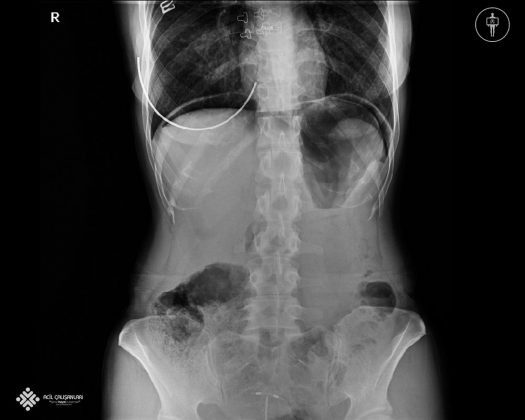 Direkt Batın Grafisi Değerlendirilmesi | Acil Çalışanları